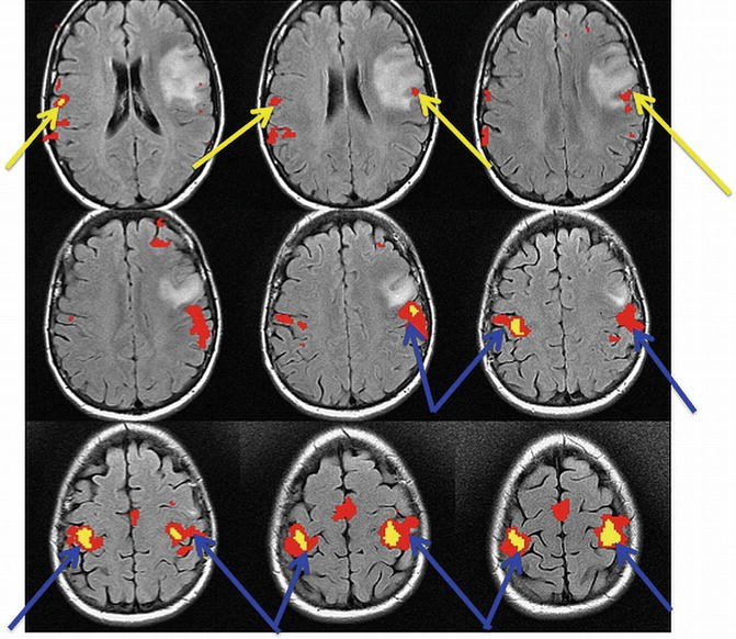How fMRI is revolutionizing Neuroscience research?