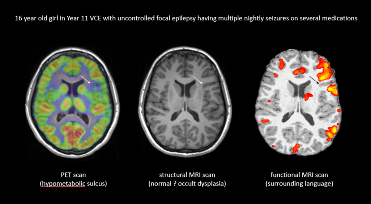 How Neuroscience Research has been revolutionized by fMRI