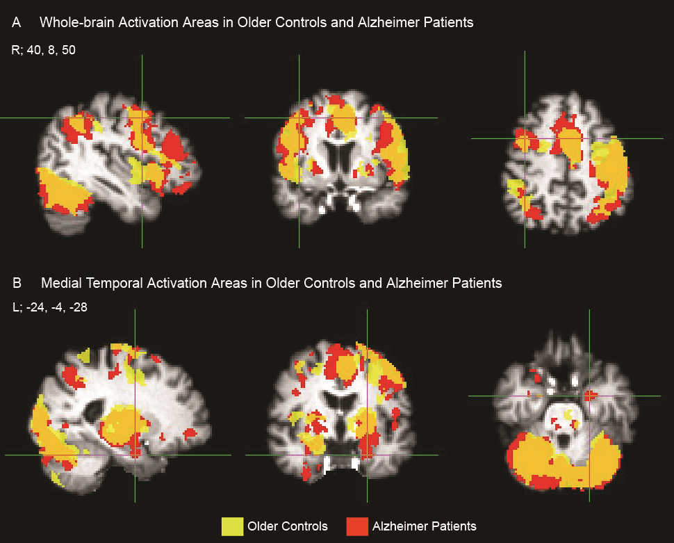 How fMRI helps treat Neurological Disorders and Trauma Patients